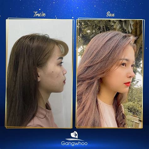 HÌnh XĂm Che SẸo LỒi ĐƯỢc KhÔng