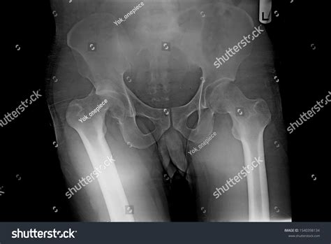 Pelvis Hip Xray Showing Posterior Hip Foto Stock 1540398134 Shutterstock