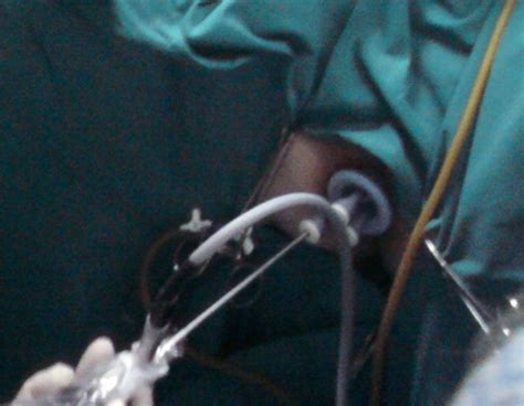 Transanal Polypectomy Using Single Incision Laparoscopic Instruments Pmc