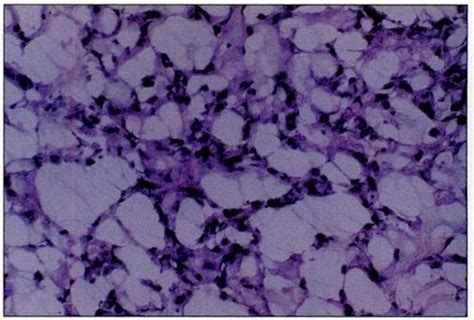 Endodermal Sinus Tumor Of The Vagina A Ct Scan Shows Solid Mass M