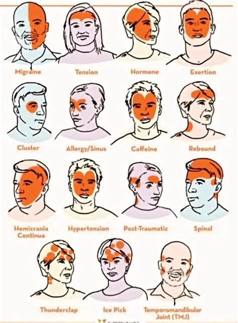 A Headache Or Cephalalgia Is Characterized By Pain In The Face Head