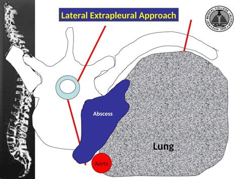 7 Presentation Spinal Tuberculosis Modifiedppt