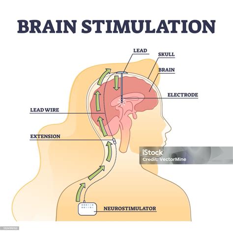 Deep Brain Stimulation Procedure Educational Explanation Outline