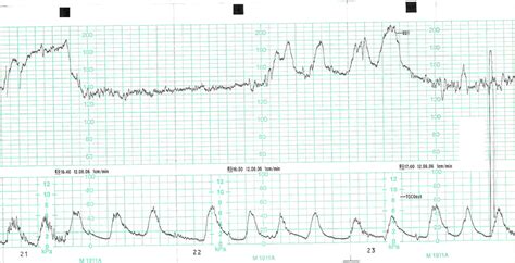 Interpreting Cardiotocograph Tracings The Bmj