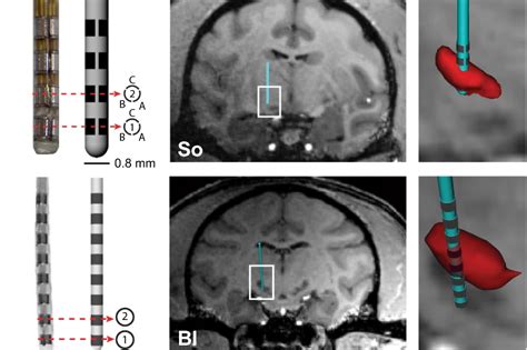 New Insights For Fine Tuning Deep Brain Stimulation Settings Biomedical Engineering College