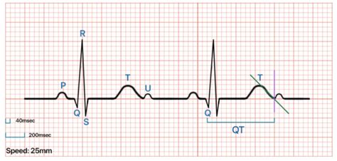 Qt Interval What Every Clinician Should Know Fullagonist