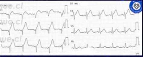 Stemi And Stemi Equivalents Ie Who Needs The Cath Lab Now — Taming