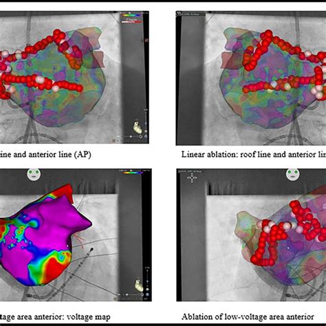 Examples Of 3d Maps With Typical Ablation Lesion In Groups A And B