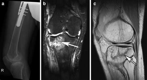 Of Insufficiency Fractures Radiology Key