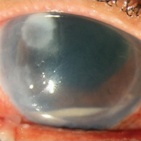 Late Infective Keratitis With Interface Hypopyon Download Scientific Diagram