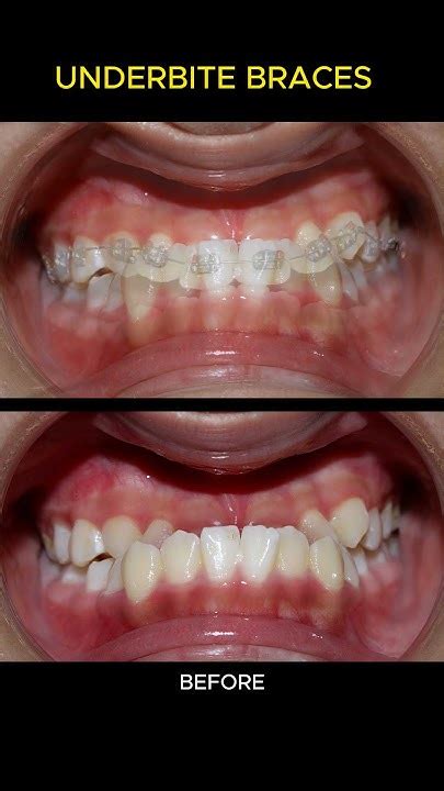 Braces Process Underbite Youtube