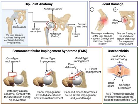 Outcomes And Complications Of Hip Arthroscopy For Femoroacetabular Impingement Syndrome A