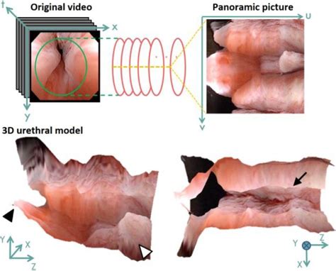 Urine Flow Dynamics Through Prostatic Urethra With Tubular Organ
