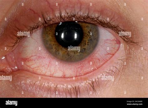 Close Up Of The Reddened Eye Of A 34 Year Old Male Patient With Acute
