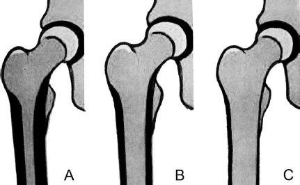 Dorr Femoral Bone Classification Type A Narrow Canal Open I