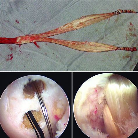 Double Bundle Posterior Cruciate Ligament Reconstruction Using Achilles