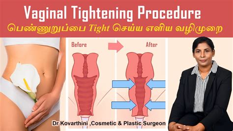 Vaginal Tightening Procedure Vaginoplasty Ko Cosmetic Surgery