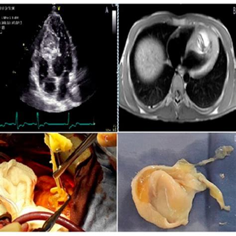 Pdf The Interventricular Septum Structure Function Dysfunction And Diseases