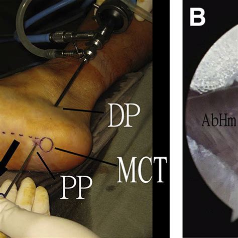 B Measurement Of Popliteal Angle Test Download Scientific Diagram