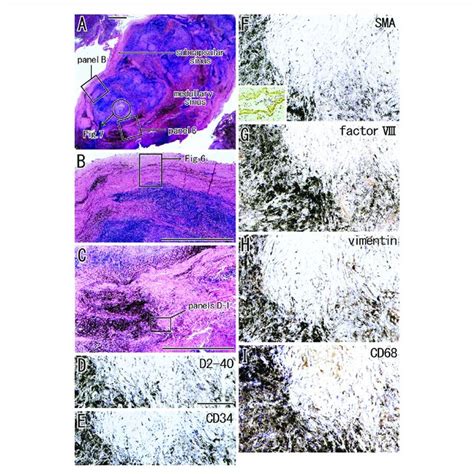 Hyalinization And Pre Hyalinization In Thoracic Nodes Download
