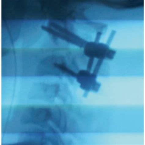Pdf C2 Parspedicle Screws In Management Of Craniocervical And Upper