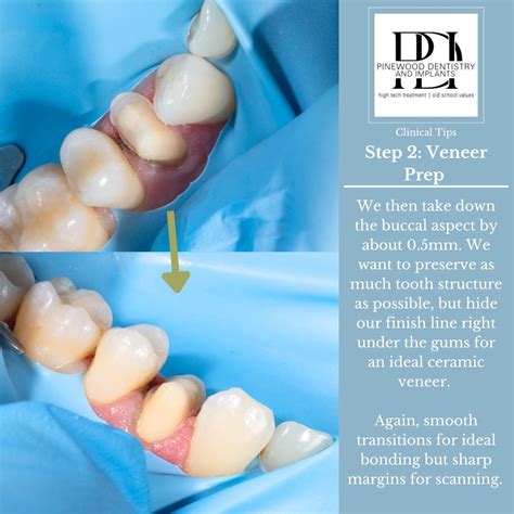 Clinical Tips 5 Vonlay After Rct Fantaskismiles