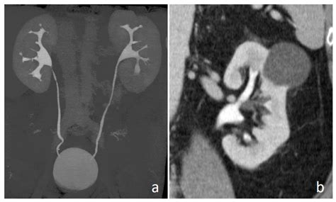 Ct Urography Dual Triple Phase Organ Imaging Noble Imaging And