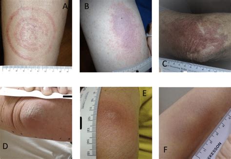 MEDICAL DETECTIVE Lets Talk About Lyme Rashes LymeDisease Org