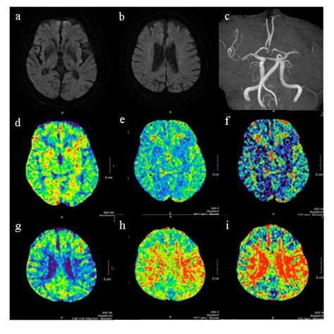 Dense Basilar Artery Dot Sign 4 Download Scientific Diagram