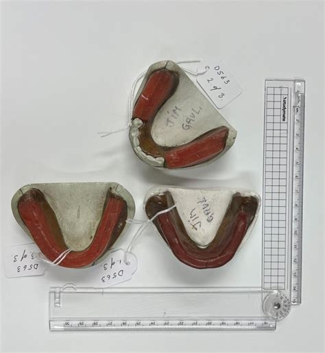 Wax Bite Registration Rims Contour Models Jim Gaul Dental Technician Unkno Ehive