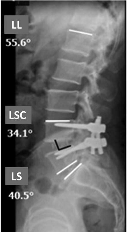 Lateral Spine Radiograph Demonstrating The Angular Measurements After
