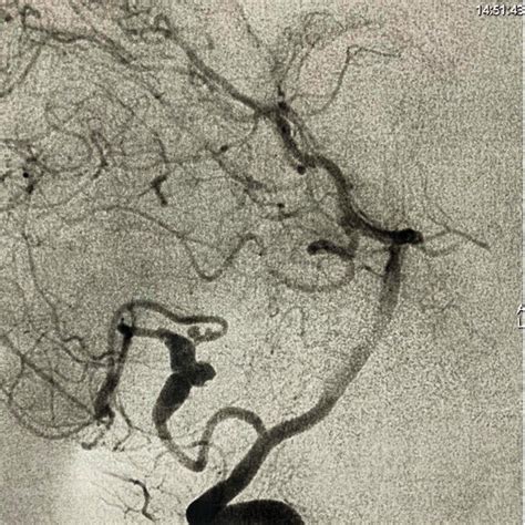 Diagnostic Cerebral Angiogram Showing A Right Posterior Inferior
