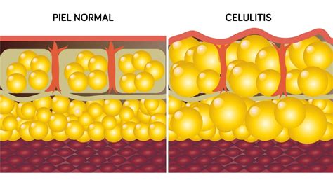 Que Es La Celulitis Y Cuantos Tipos Existen Celulitis Qué Es Cómo