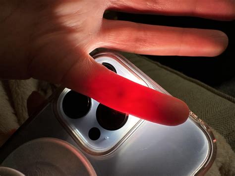 Spontaneous Blue Nodule On Finger Rdiagnoseme