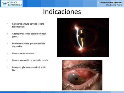 Glaucoma Implante Ex Press Vs Trabeculectomia Ppt Descarga Gratuita