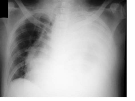 Chest X Ray Shows Mediastinal Shift To The Right And Leftsided