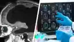 Man Was Found To Be Missing 90 Of His Brain But Was Still Living A