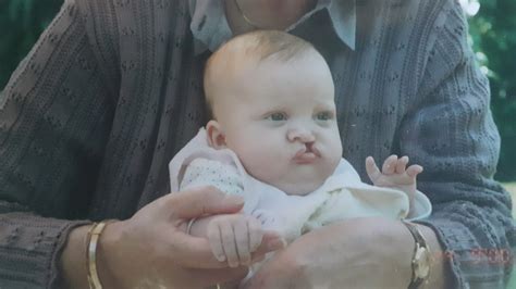 Bibi 22 Werd Geboren Met Schisis Een Hazenlip Het Hoort Bij Mij Linda Nl