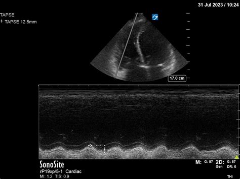 Icuadventures4 Preload And Afterload Assessment From Critical Care