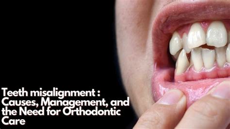 Understanding Teeth Misalignment Causes Management And The Need For
