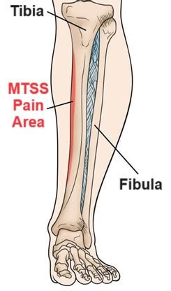 Medial Tibial Stress Syndrome Causes And Treatment Of Shin Splints