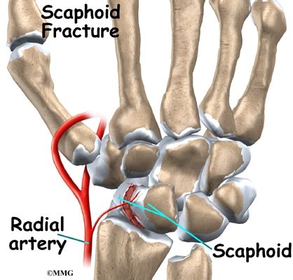 Scaphoid Fracture Of The Wrist