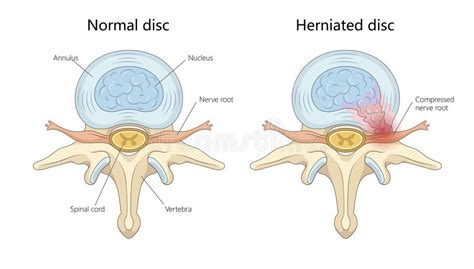 Spinal Nerve Root Stock Illustrations 152 Spinal Nerve Root Stock Illustrations Vectors