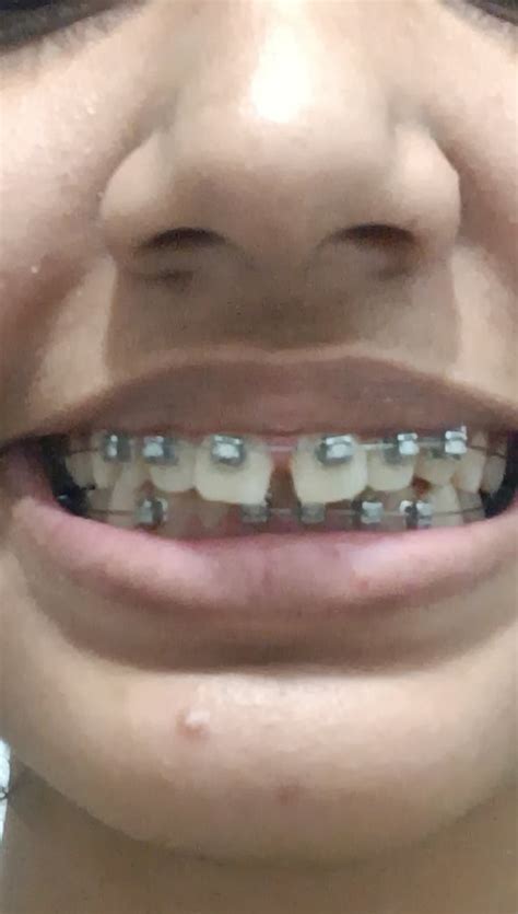 Braces Progress Rbraces