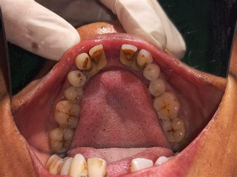 Caries Object Detection Model By Betic