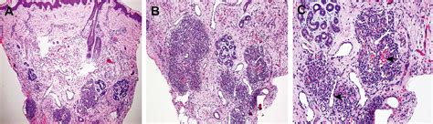 Histopathology Of Vascular Tumors Dermatologic Clinics