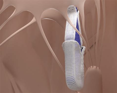 The Pascal Precision System Edwards Lifesciences