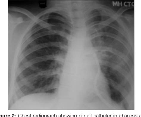 Figure 2 From Fibrinolytics In Loculated Abscess Cavities A Report Of Two Cases Semantic Scholar
