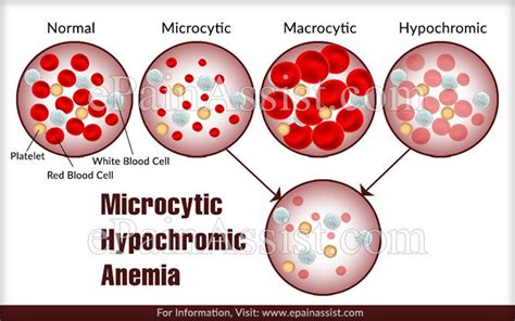 What Is Microcytic Hypochromic Anemia Causes Symptoms Treatment