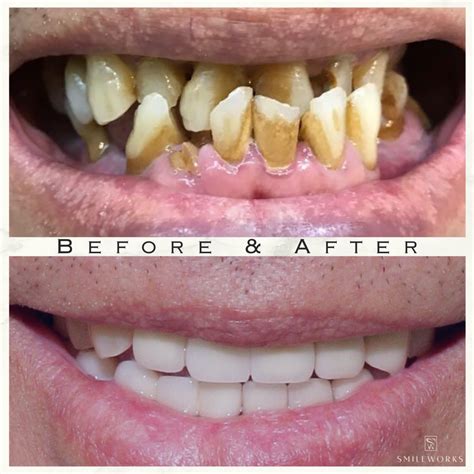 Full Mouth Rehabilitation World Class Dentistry